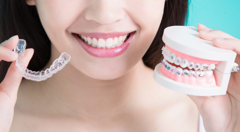 5 Different Types of Retainers: Which Is Right for You?