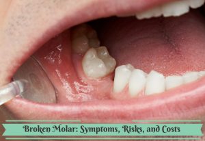 Broken Molar: Symptoms, Risks, and Costs