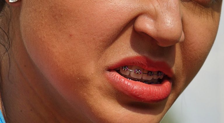 Swollen Gums With Braces- What Does it Mean for Your Oral Health
