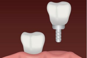 Broken Molar: Symptoms, Risks, and Costs