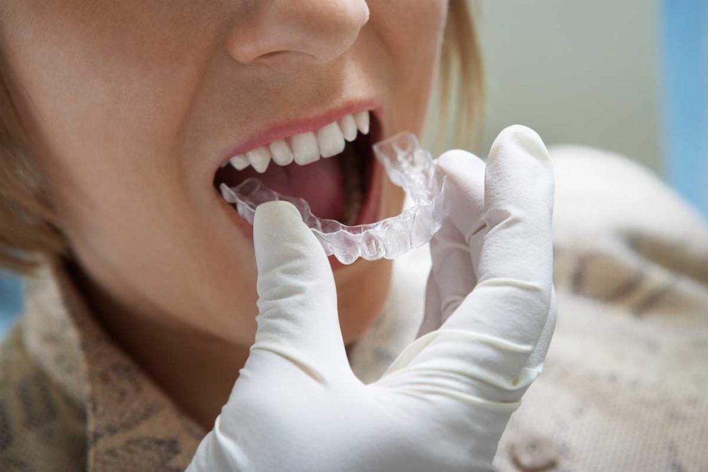 Mouth Guard For Teeth Grinding What To Look For And How It Works Mouth Guard For Teeth Grinding What To Look For And How It Works