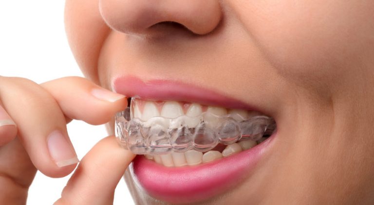 5 Different Types of Retainers: Which Is Right for You?