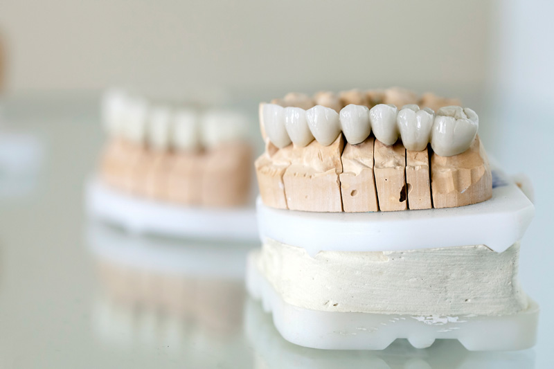 What Are The Different Types Of Veneers