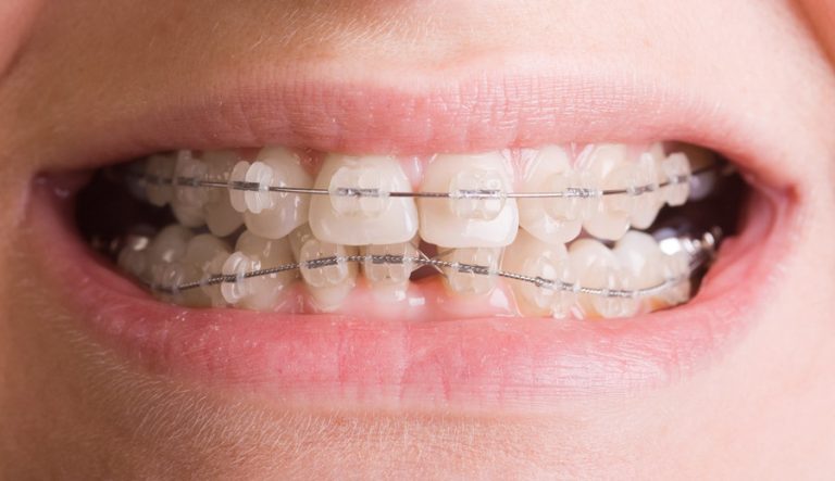 Teeth Shaving: What it is and Why Your Dentist Would Prescribe it