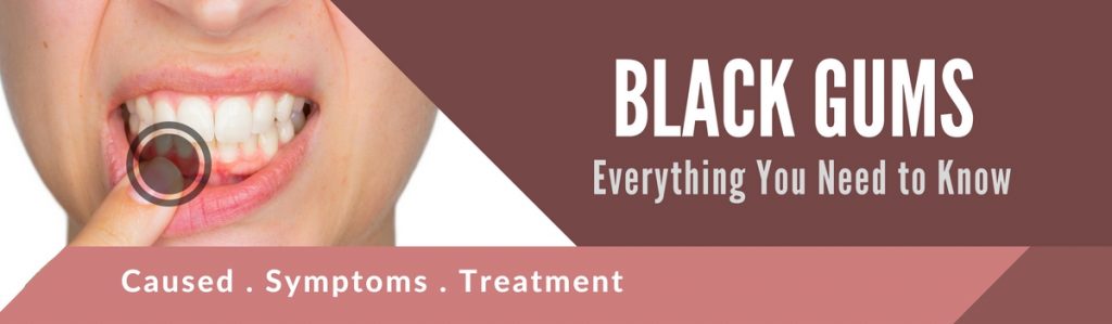 Black Gums: Everything You Need to Know