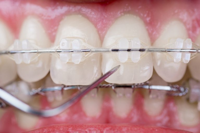 Can You Straighten Teeth Without Braces?