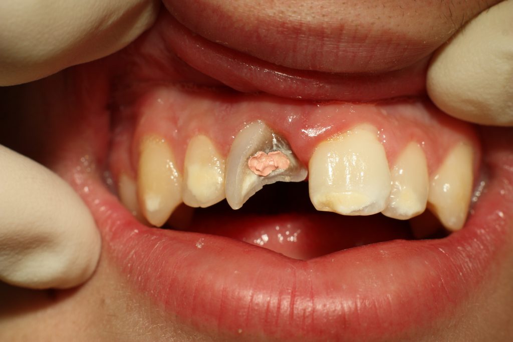 Chipped Teeth? Tips on Handling Chipped Teeth