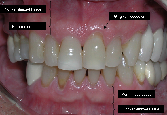 Chronic Periodontitis: Causes, Symptoms & Treatment Chronic Periodontitis: Causes, Symptoms & Treatment