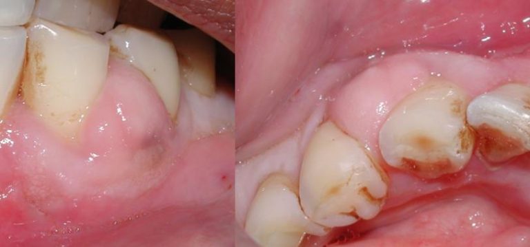 Commonly Experienced Dental Bridge Problems & How to Avoid Them