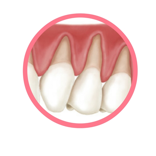 Receding Gums: A Gradual And Common Dental Problem