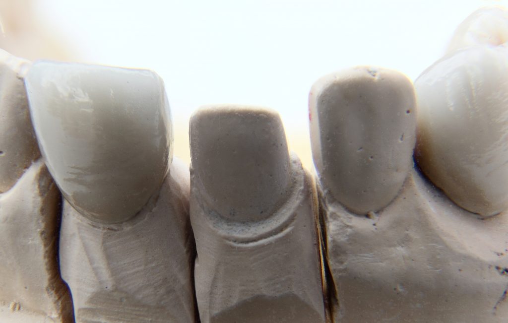 Broken Crown? What to Do If You Have a Cracked Dental Crown