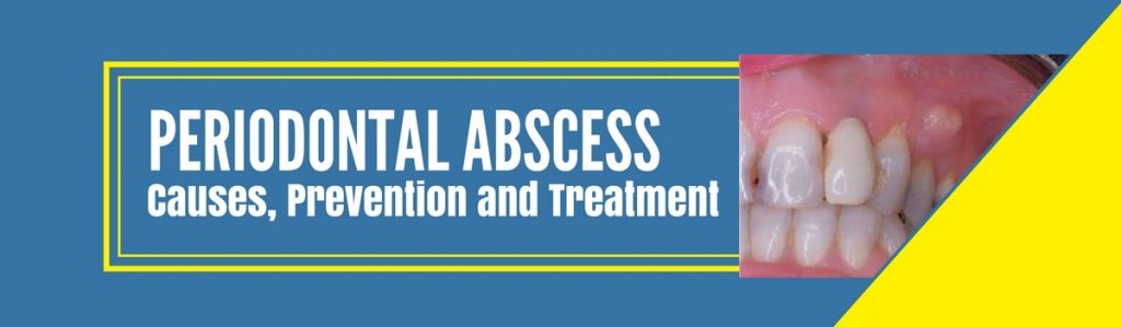 Periodontal Abscess: Causes, Prevention and Treatment