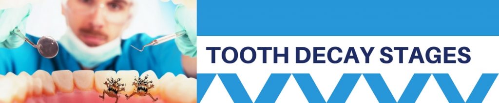 Tooth Decay Stages: What's Happening Inside Your Teeth?